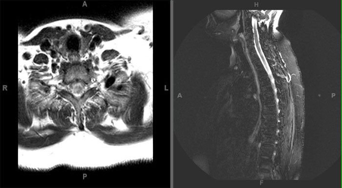Lumbar Spine Lumbar Spine Wo Contrast