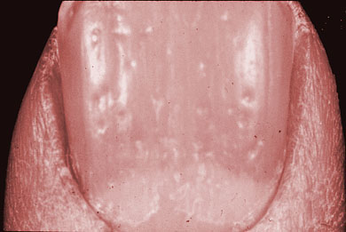 Psoriatic Arthritis Clinical Manifestations • Arthritis Information